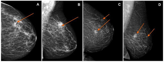 Multifocality and Multicentrality in Breast Cancer: Comparison of the ...