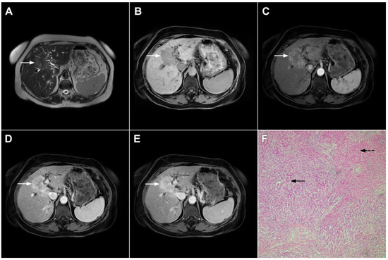 Current Oncology | Free Full-Text | Imaging Spectrum of Intrahepatic Mass-Forming ...