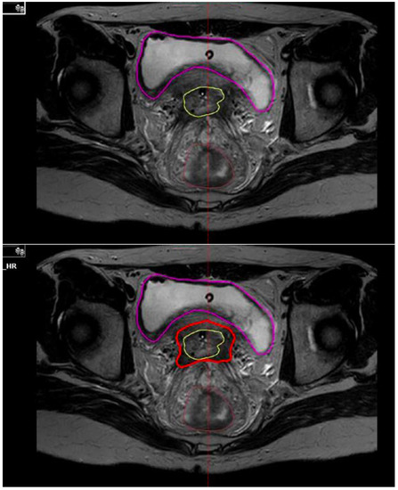 Advances in Radiation Oncology for the Treatment of Cervical Cancer