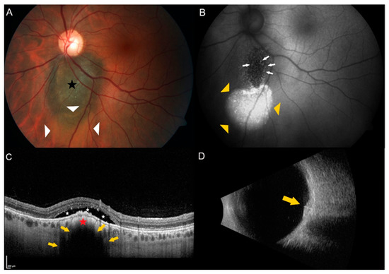 Assessing Choroidal Nevi, Melanomas and Indeterminate Melanocytic ...