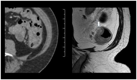 CT and 3 Tesla MRI in the TN Staging of Colon Cancer: A Prospective ...
