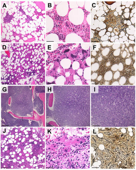 Chronic Lymphocytic Leukemia Bone Marrow