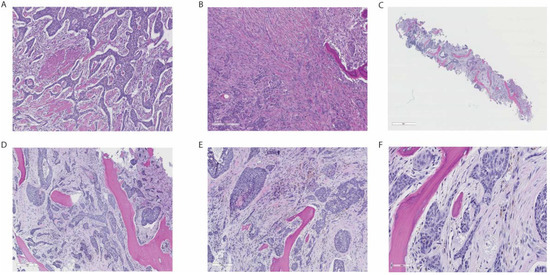 Basosquamous Basal Cell Carcinoma with Bone Marrow Metastasis