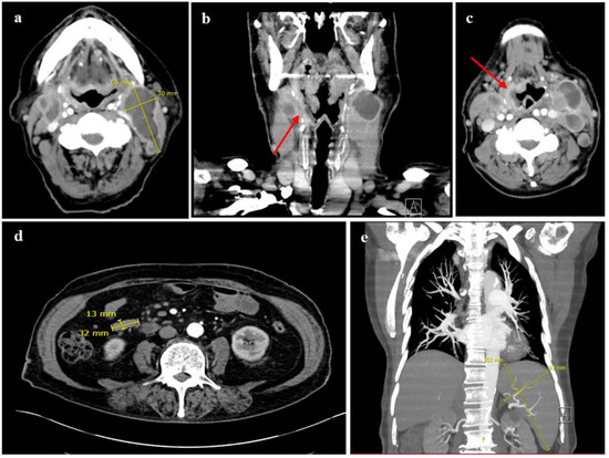 Co-Occurrence of EBV-Positive Mucocutaneous Ulcer (EBV-MCU) and CLL/SLL ...