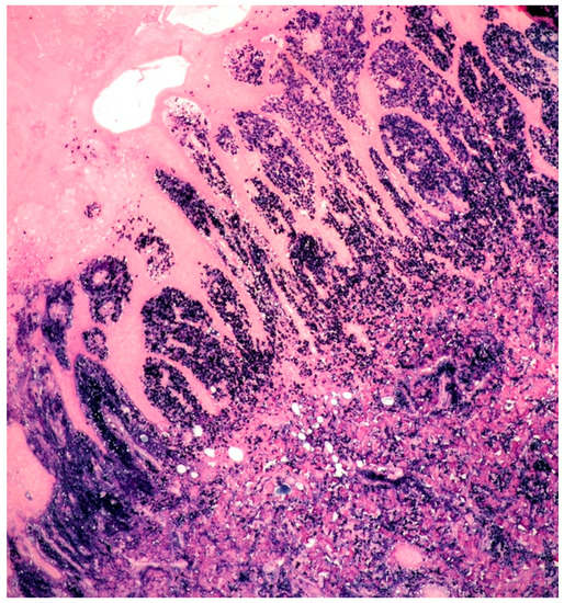 Cutaneous Involvement in Diseases with Plasma Cell Differentiation ...