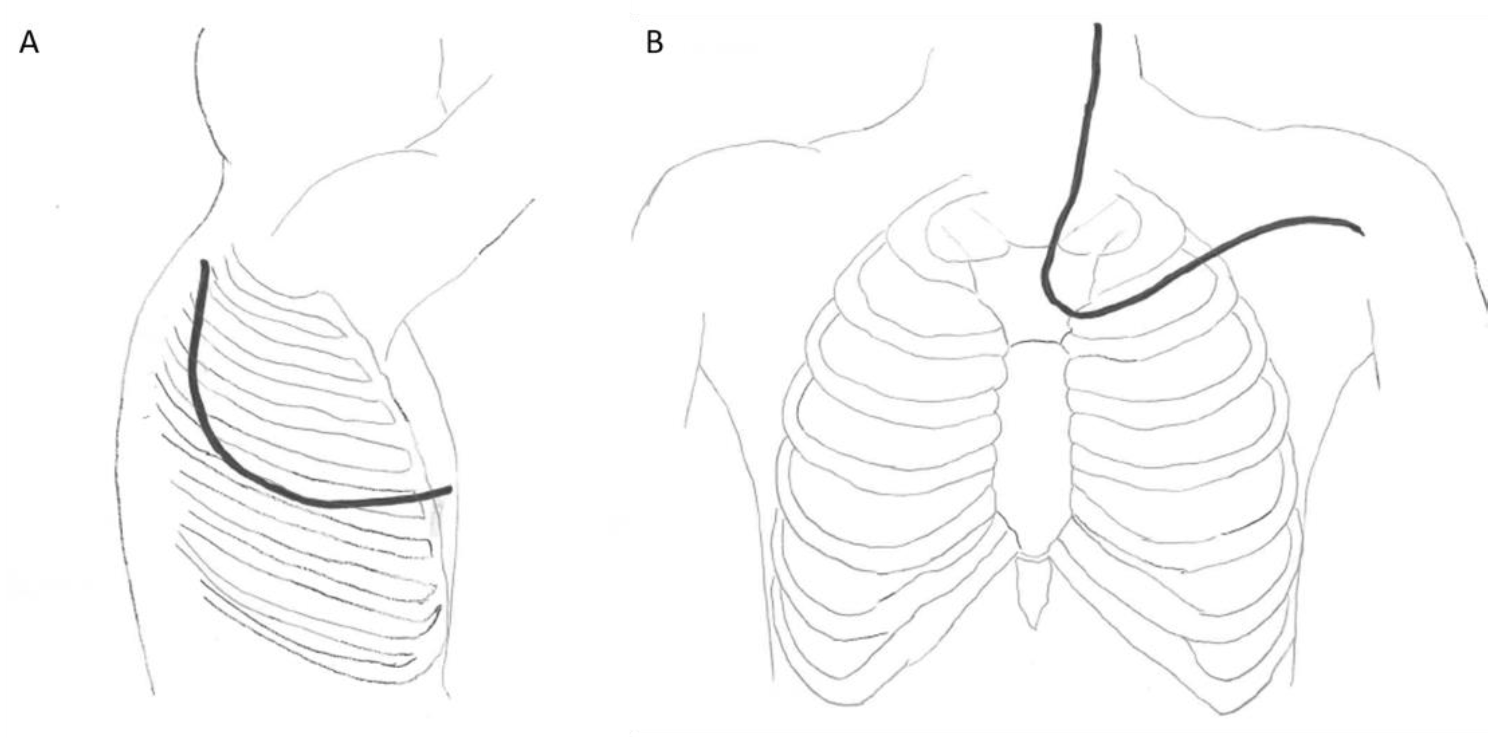 Posterolateral Thoracotomy