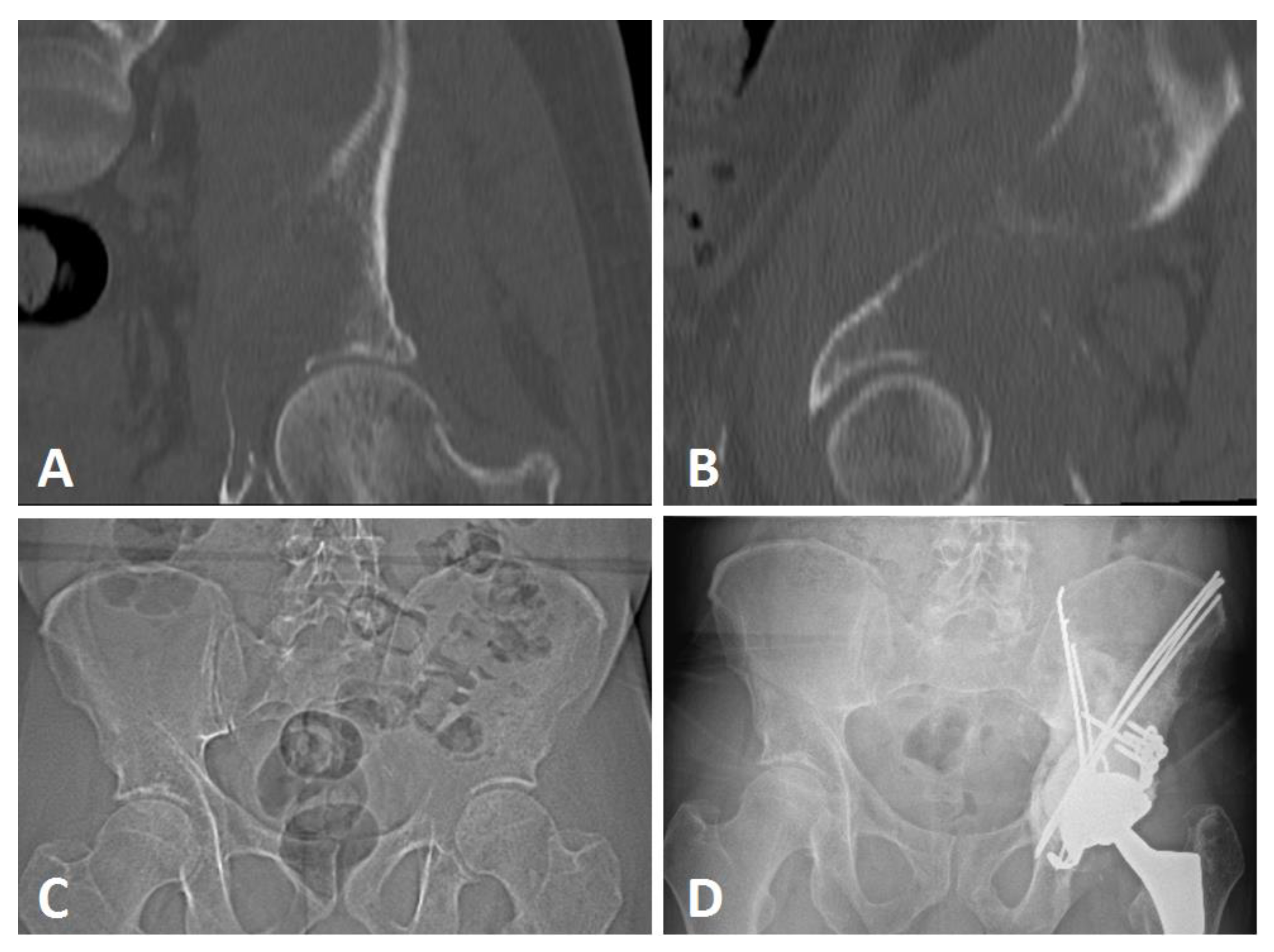 Functional and Survival Outcomes of Patients following the Harrington ...