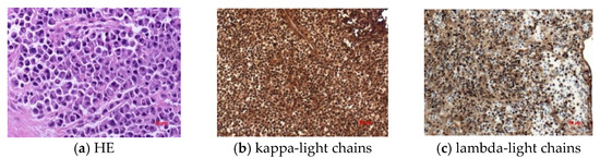 Spinal Lesions as Clinical Manifestations of Plasma Cell Neoplasia