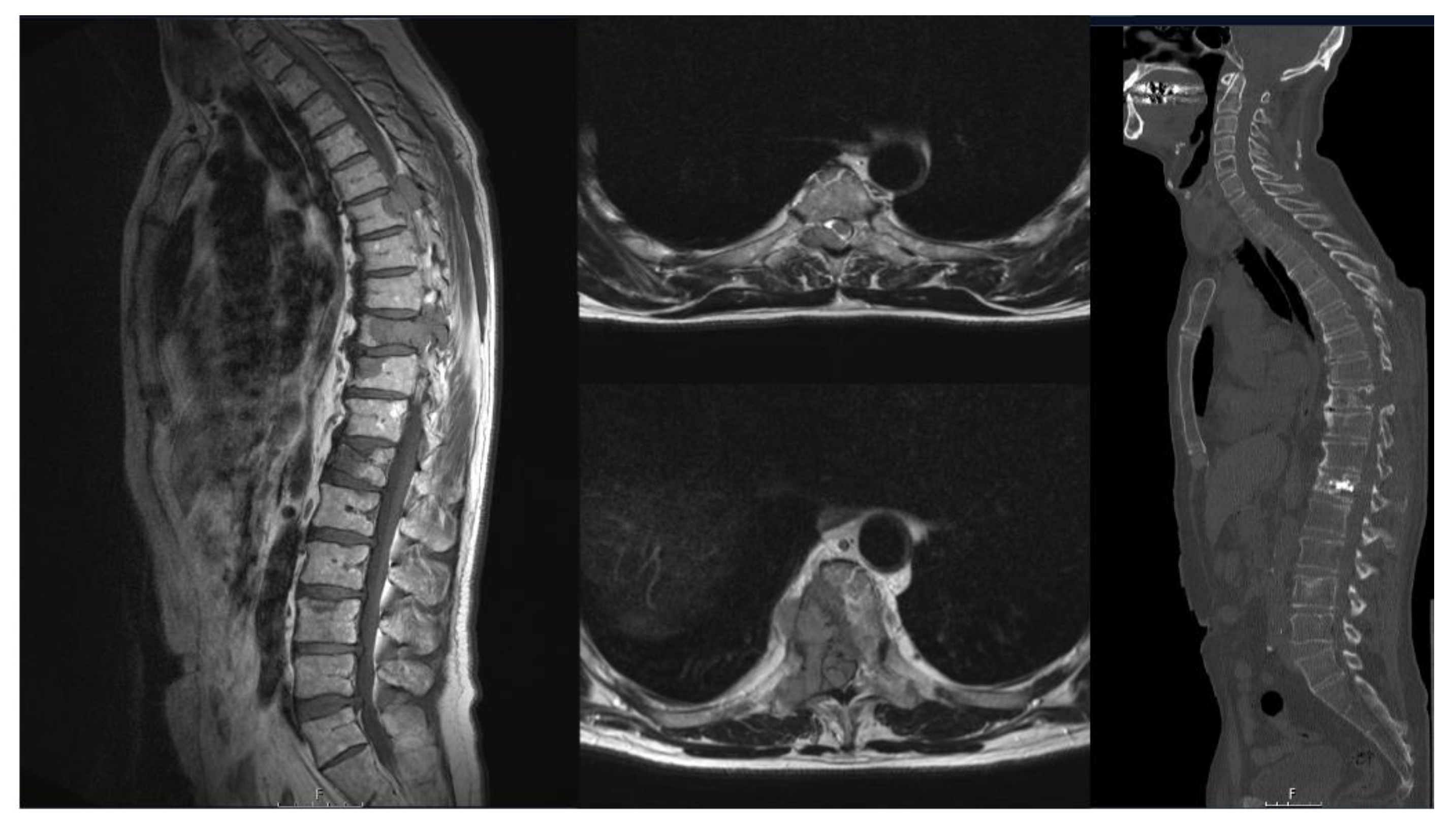Spinal Lesions as Clinical Manifestations of Plasma Cell Neoplasia