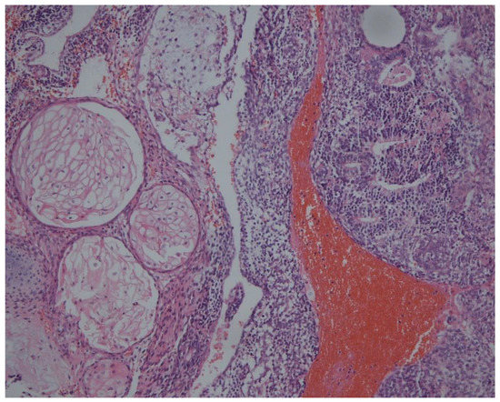 Growing Teratoma Syndrome with Synchronous Gliomatosis Peritonei during ...