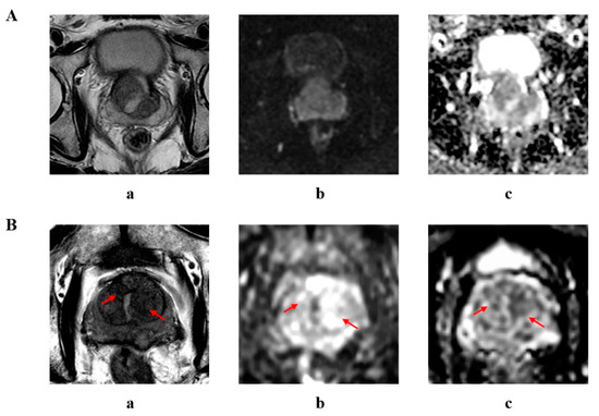 Current Oncology | Free Full-Text | The Diagnostic Value of PI-RADS v2 ...