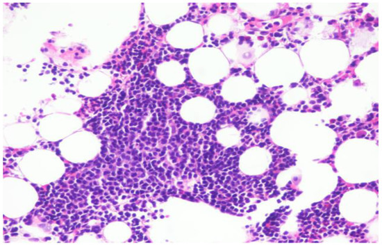 Therapeutic Management of Chronic Lymphocytic Leukemia Presenting with ...