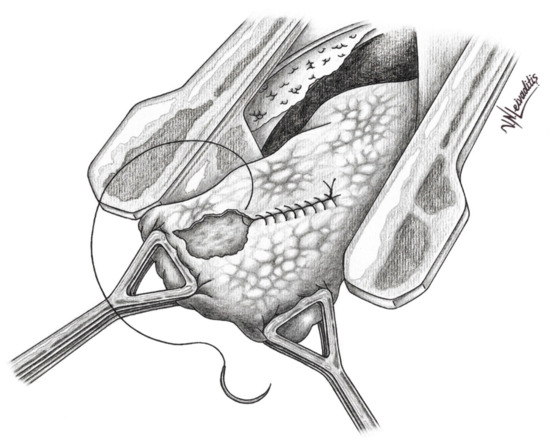 Lung Metastatectomy: Can Laser-Assisted Surgery Make a Difference?