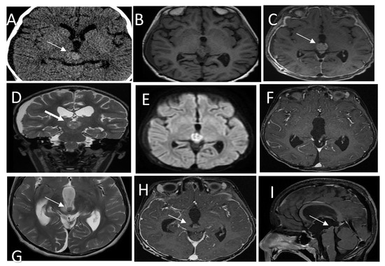 Papillary Tumor of the Pineal Region Rare Pediatric CNS Tumor Case ...