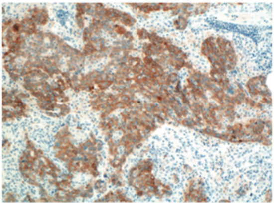 Therapeutic Advances of Rare ALK Fusions in Non-Small Cell Lung Cancer