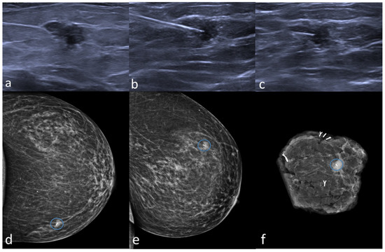 Efficacy and Accuracy of Using Magnetic Seed for Preoperative Non ...