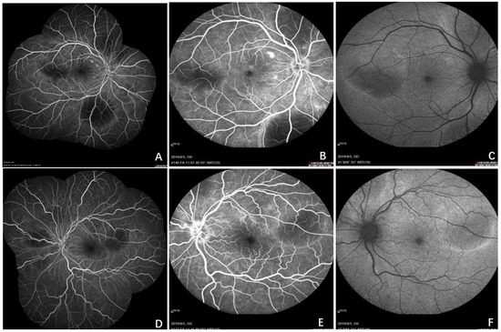 Value of Combined Diagnosis for Choroidal Lymphoma: A Case Report