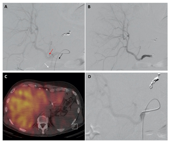 Current Oncology | Free Full-Text | Temporary Reversal of Hepatoenteric ...