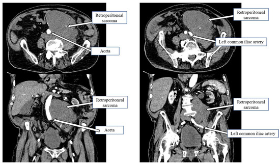 Morbidity and Mortality after Surgery for Retroperitoneal Sarcoma