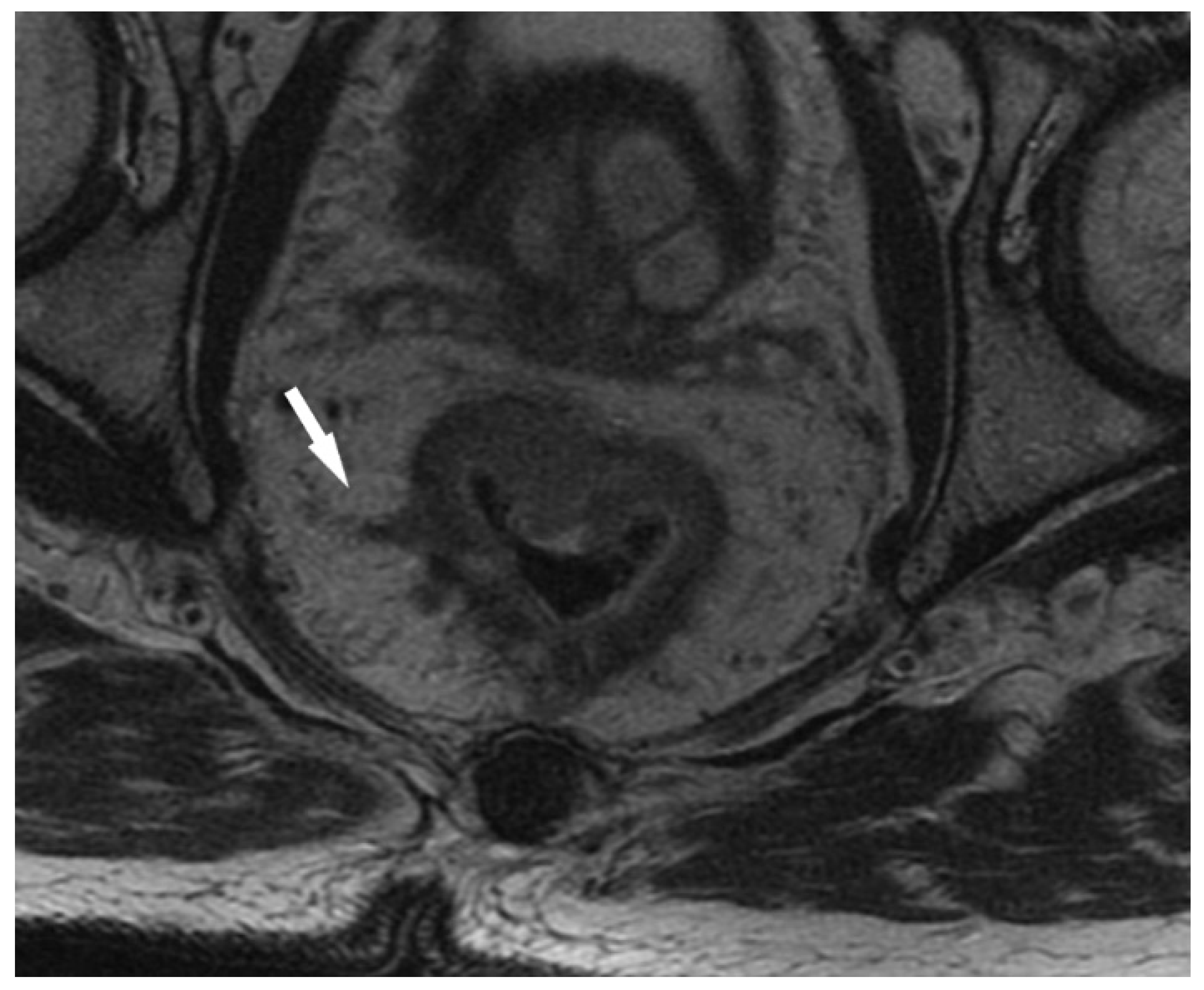 Correlation between Lymphocyte-to-Monocyte Ratio (LMR), Neutrophil-to ...