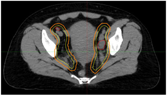 The New Kid on the Block: Online Adaptive Radiotherapy in the Treatment ...