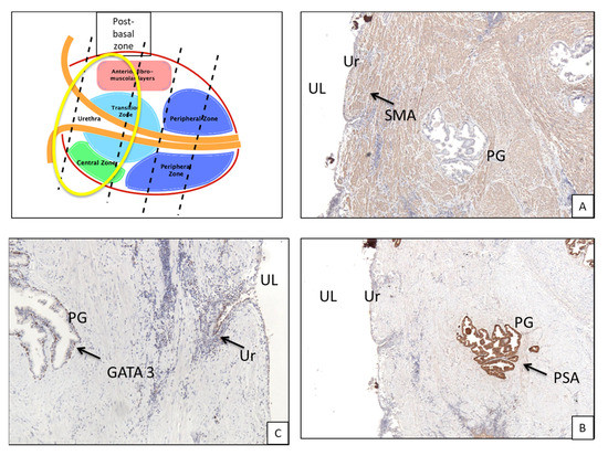 “Urethral-Sparing” Robotic Radical Prostatectomy: Critical Appraisal of ...