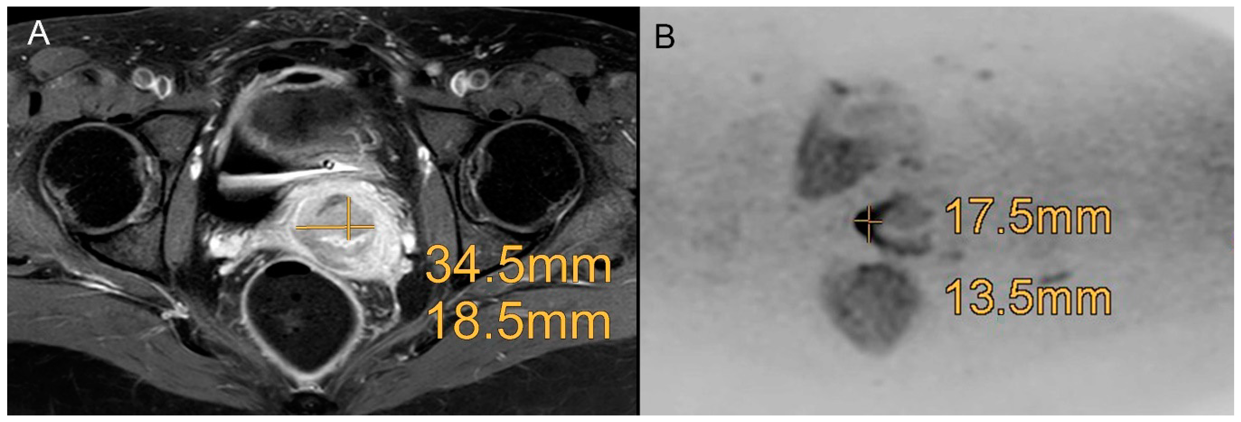 Diagnostic Value of Diffusion-Weighted Imaging with Background Body Signal Suppression (DWIBS ...