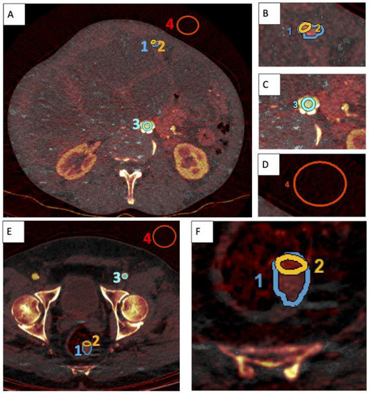 Spectral Computed Tomography-Derived Iodine Content and Tumor Response ...
