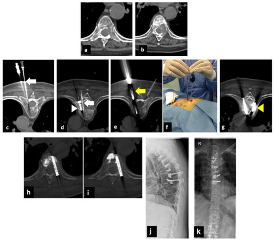 Percutaneous Ct Guided Microwave Ablation Combined With Pedicle Screw