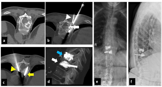 Percutaneous Ct Guided Microwave Ablation Combined With Pedicle Screw