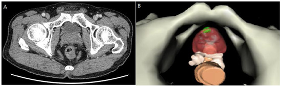 Incorporating VR-RENDER Fusion Software in Robot-Assisted Partial ...