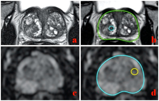 Radiomic Machine-Learning Analysis of Multiparametric Magnetic ...