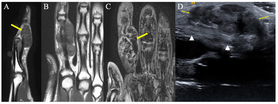 Soft Tissue Masses of the Hand: A Review of Clinical Presentation and ...