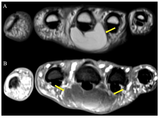 Soft Tissue Masses of the Hand: A Review of Clinical Presentation and ...