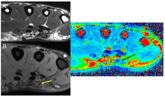 Soft Tissue Masses of the Hand: A Review of Clinical Presentation and ...