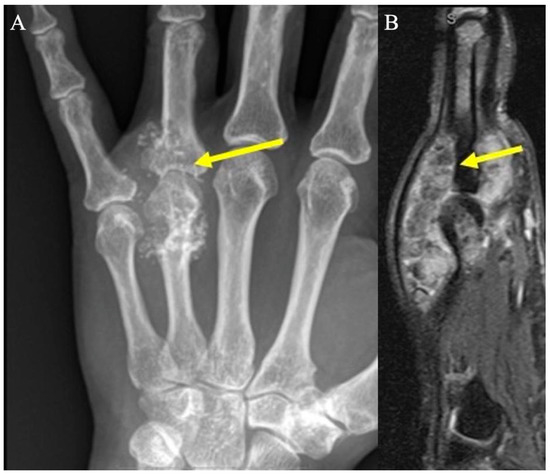 Soft Tissue Masses of the Hand: A Review of Clinical Presentation and ...