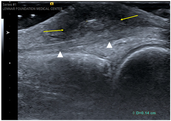 Soft Tissue Masses of the Hand: A Review of Clinical Presentation and ...