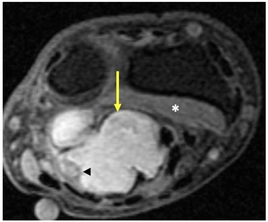 Soft Tissue Masses of the Hand: A Review of Clinical Presentation and ...