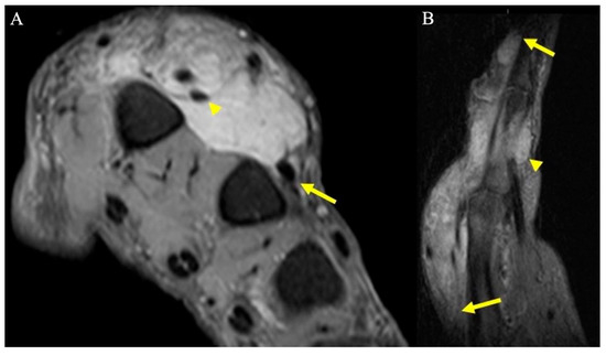 Soft Tissue Masses of the Hand: A Review of Clinical Presentation and ...