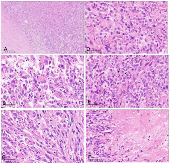 Clinical, Morphological, and Molecular Study on Grade 2 and 3 ...