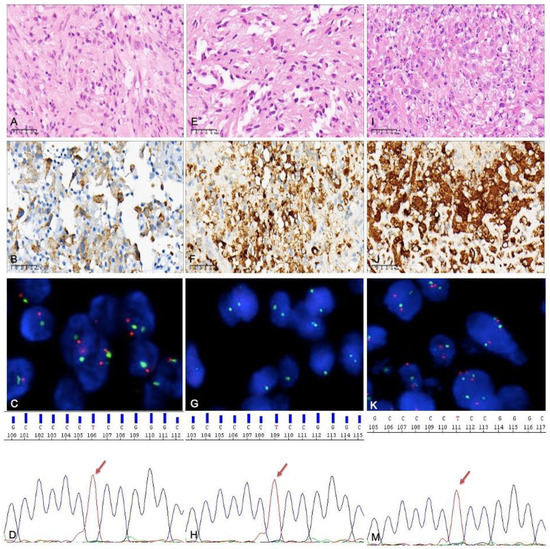 Clinical, Morphological, and Molecular Study on Grade 2 and 3 ...