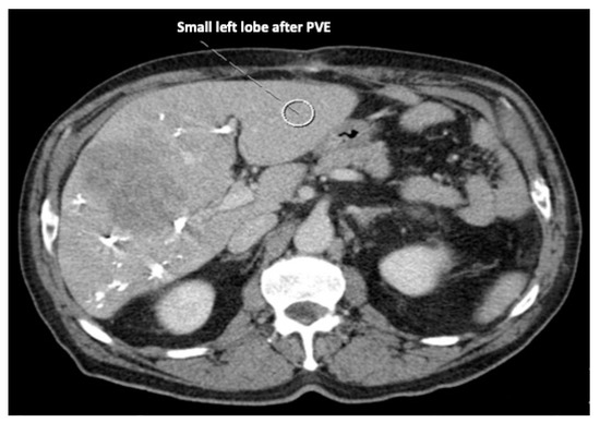 Optimizing Growth of the Future Liver Remnant and Making In-Situ Liver ...