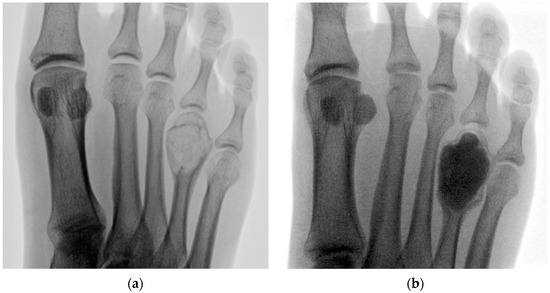 Injectable Synthetic Beta-Tricalcium Phosphate/Calcium Sulfate (GeneX ...