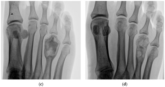 Injectable Synthetic Beta-Tricalcium Phosphate/Calcium Sulfate (GeneX ...