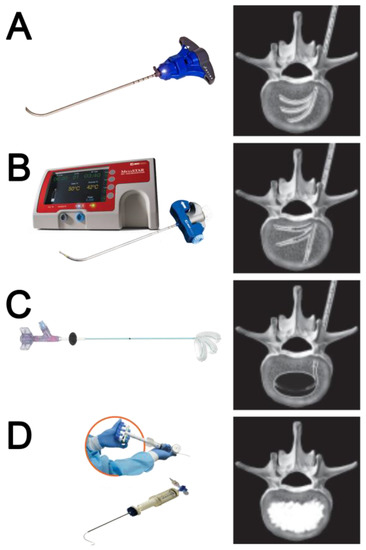 Clinical Rationale of Using Steerable Technologies for Radiofrequency ...