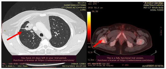 Cryoablation and Immunotherapy: An Enthralling Synergy for Cancer Treatment