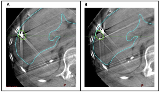 Fiducial Markers Allow Accurate and Reproducible Delivery of Liver ...