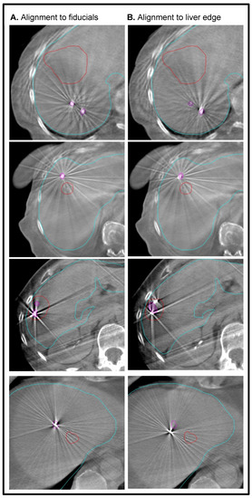Fiducial Markers Allow Accurate and Reproducible Delivery of Liver ...