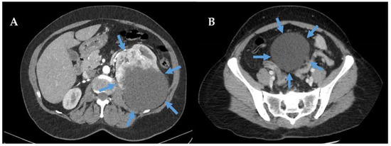 Practical Management of Adult Ultra-Rare Primary Retroperitoneal Soft ...