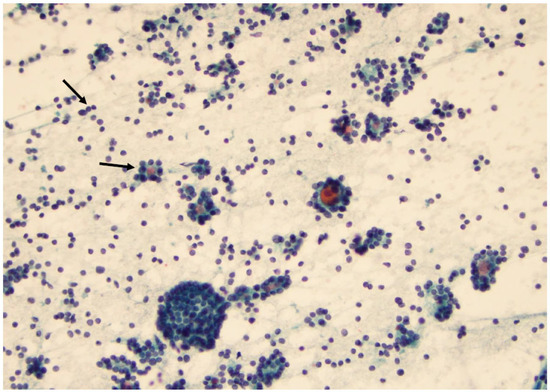 Cytology and Histology of Thyroid Nodules: Exploring Novel Insights in ...